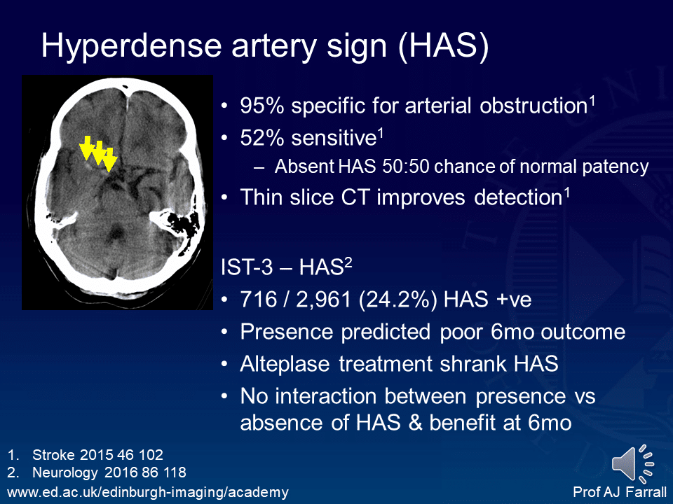 Hyperdense artery sign (HAS) - World Stroke Academy
