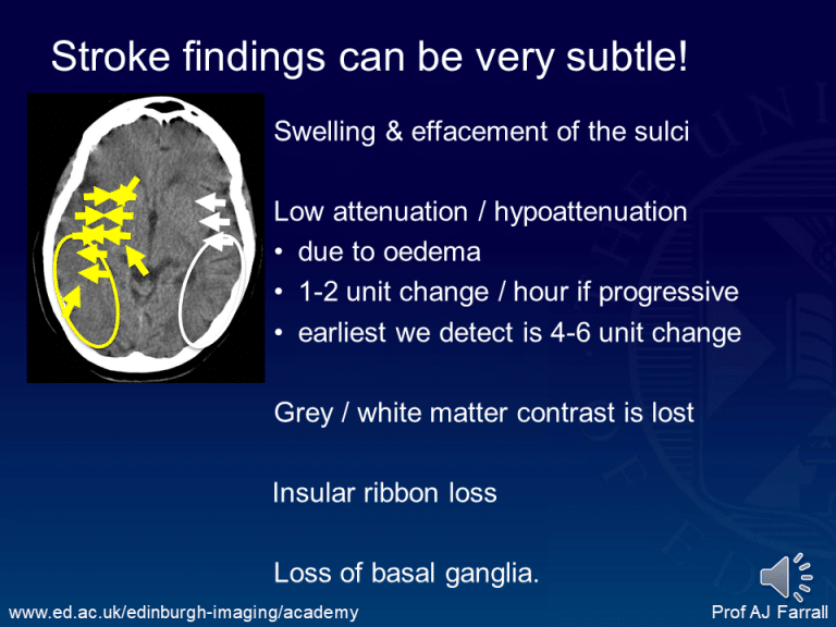 Stroke findings can be very subtle - World Stroke Academy