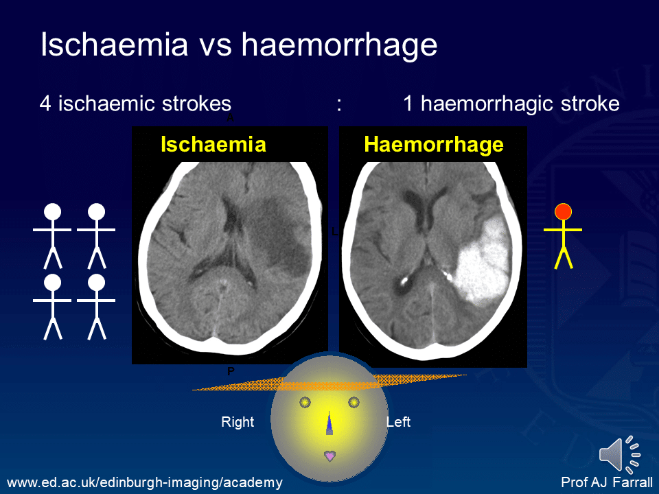 Ischaemia vs haemorrhage (II) - World Stroke Academy