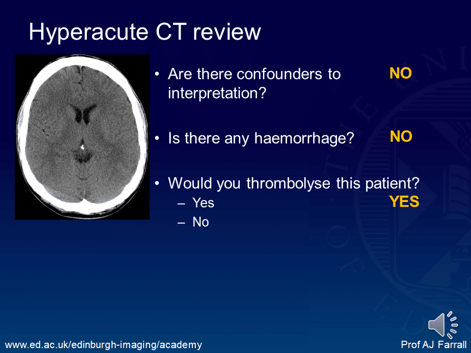 Hyperacute CT review - World Stroke Academy