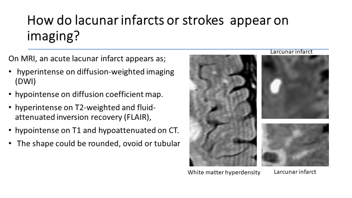 How do lacunar infarcts or strokes appear on imaging? - World Stroke ...