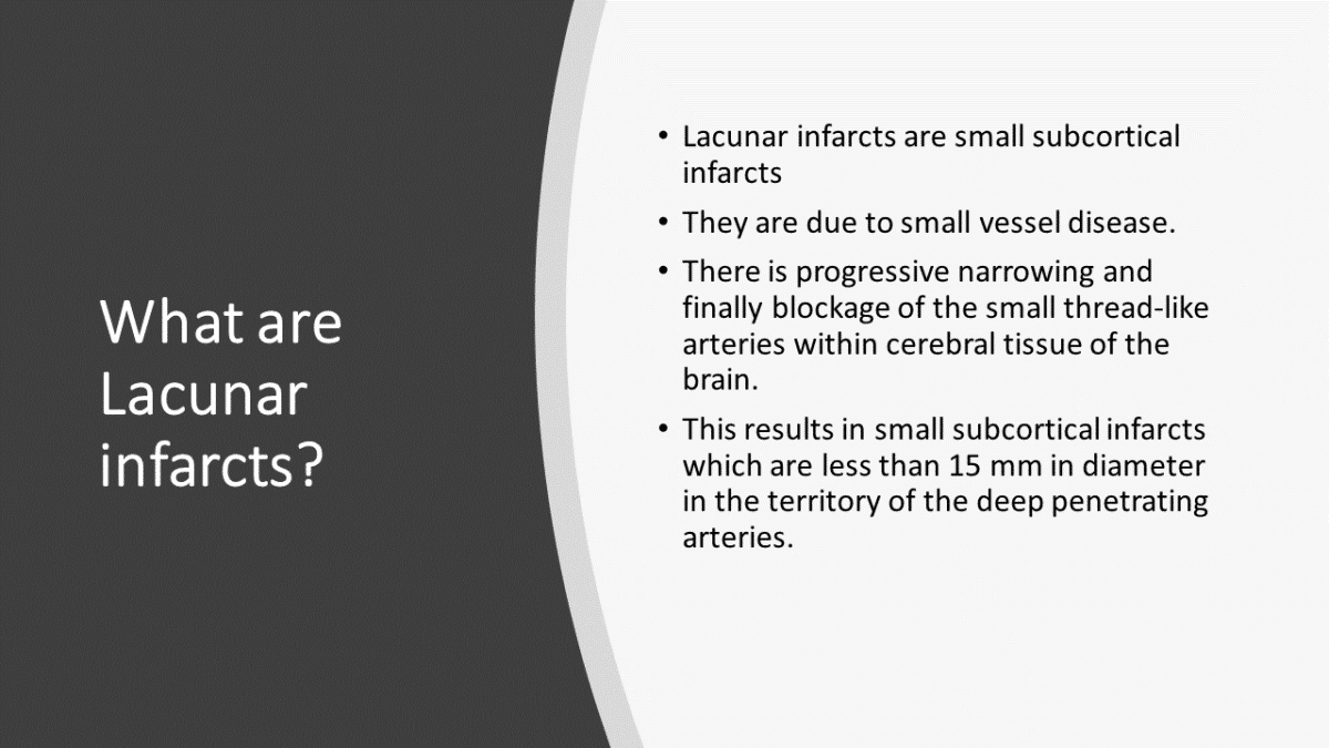 What are Lacunar infarcts? - World Stroke Academy