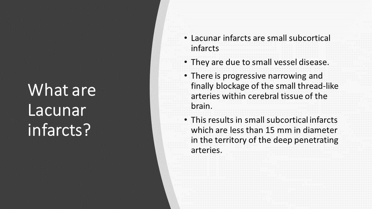 What are Lacunar infarcts? - World Stroke Academy